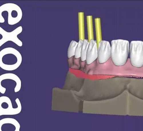 Exocad 8349 (3.1) последняя версия