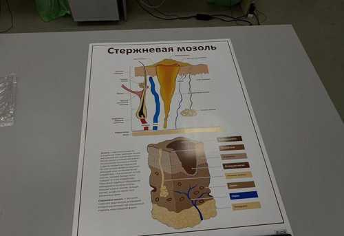 Плакат стержневая мозоль