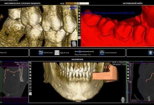 Hyperdent/3shape/ExoCad/3Diagnosys PlastyCad