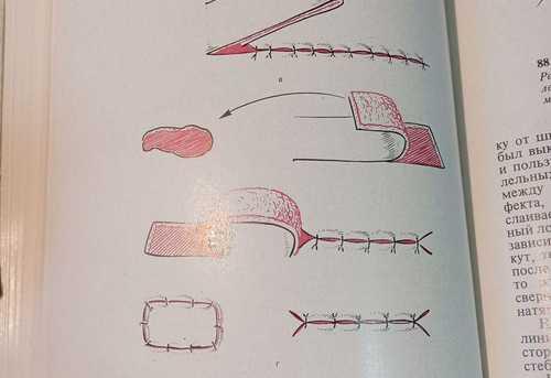 Лечение ожогов, комбустиология